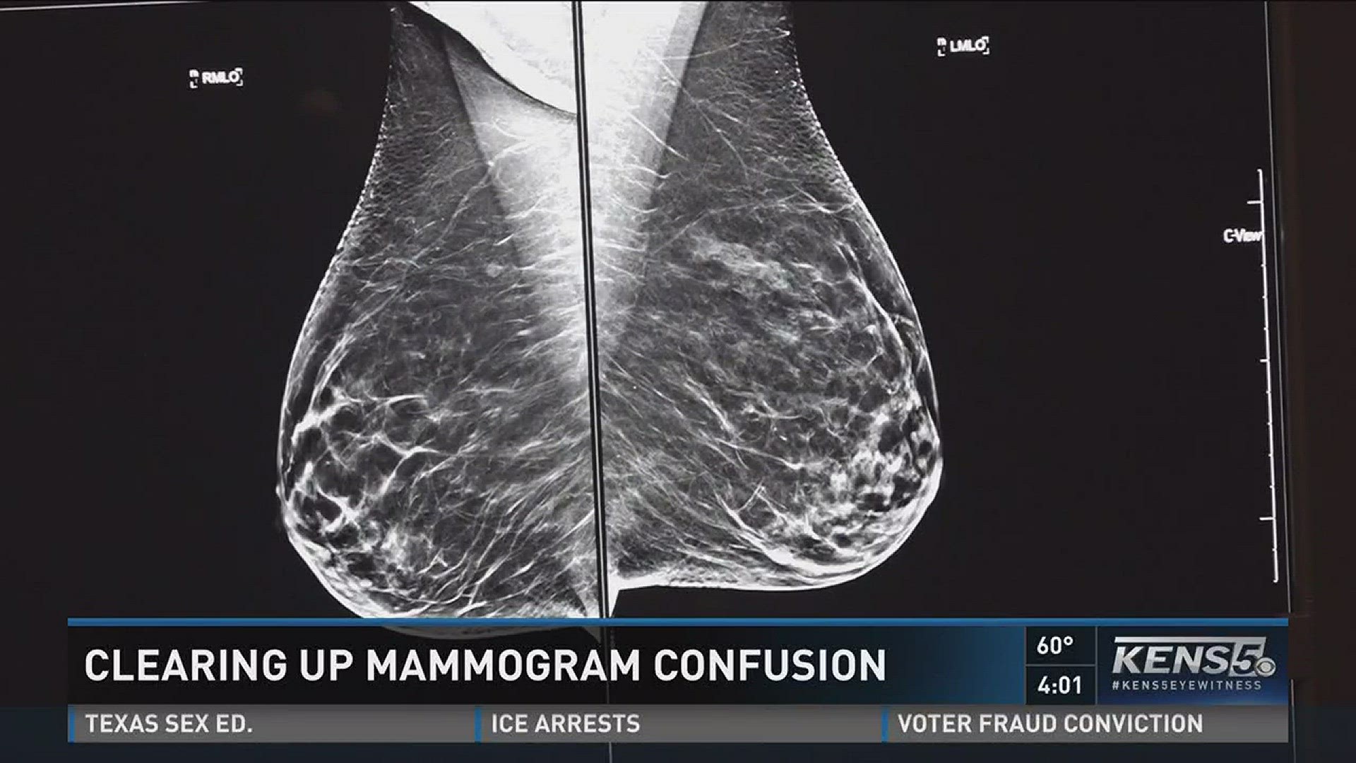 Doctors clear up confusion with mammograms | khou.com