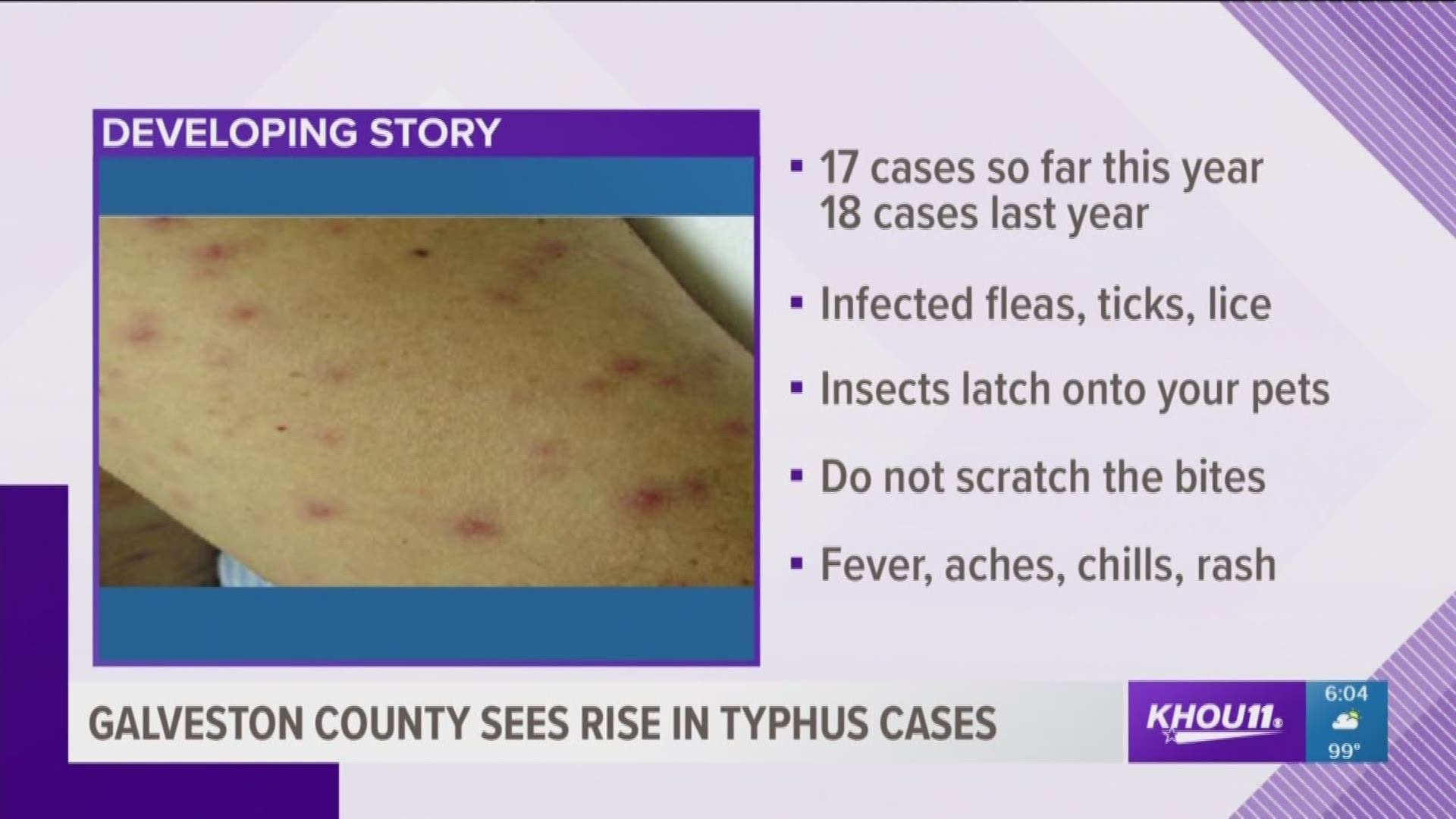 Galveston County sees rise in typhus cases | khou.com