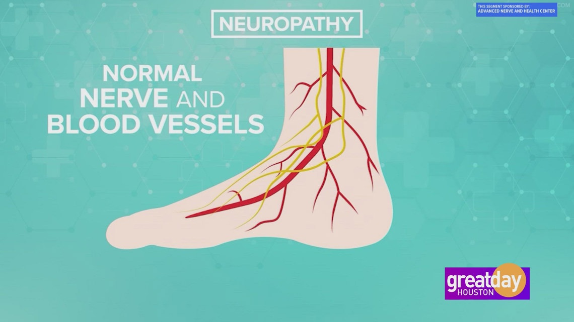 Sponsored: Reverse Your Neuropathy With Advanced Nerve And Health ...