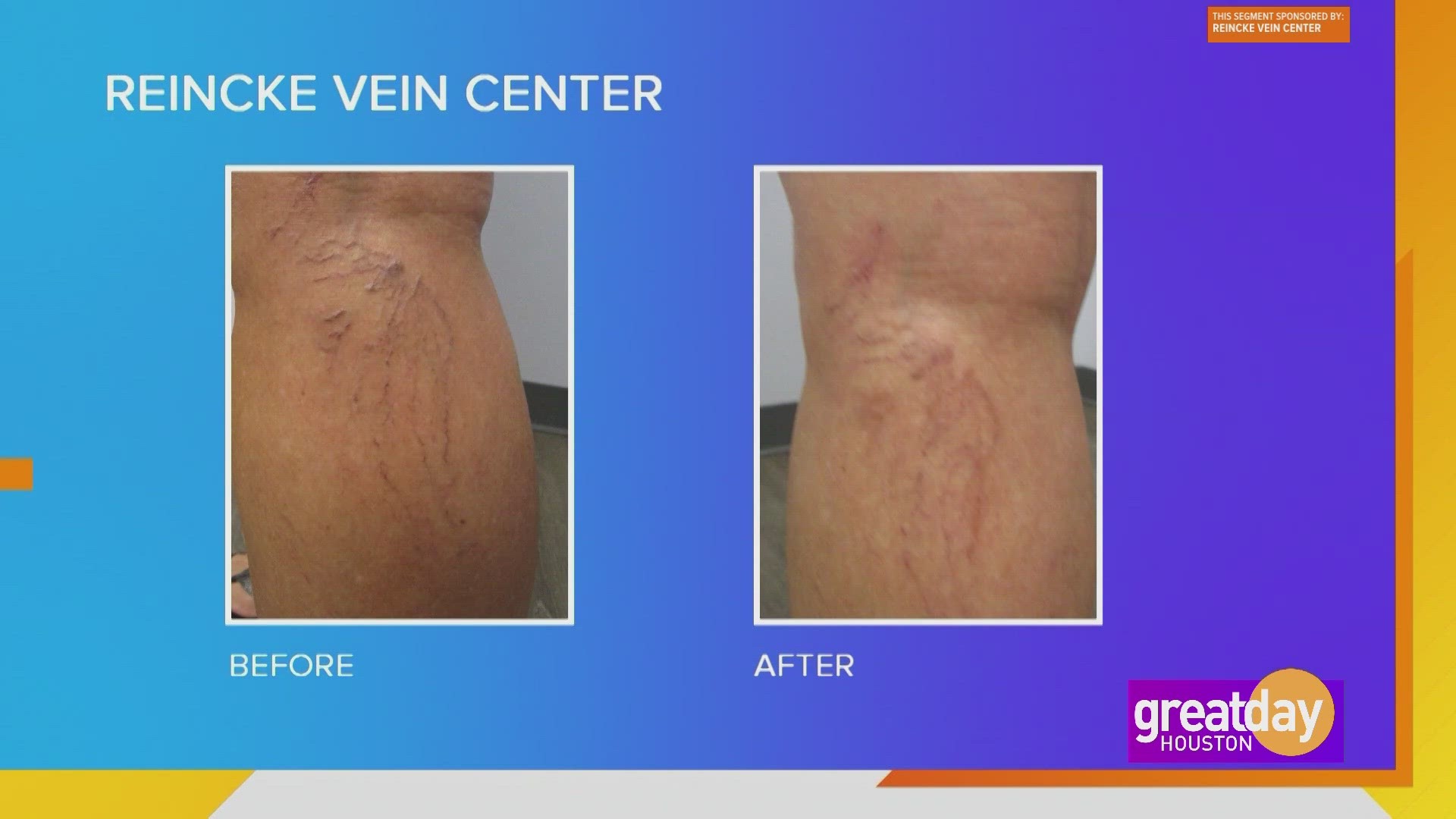 Sponsored: Find lasting relief from vein disease at Reincke Vein Center ...