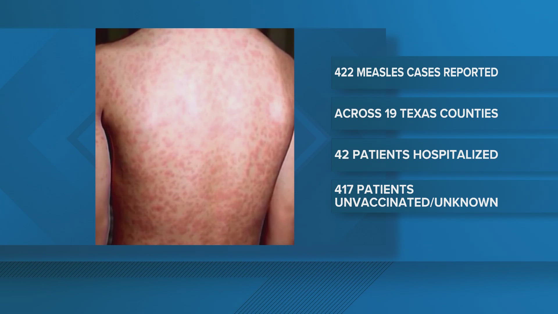 Texas measles cases rise to 422 with 42 hospitalized | khou.com