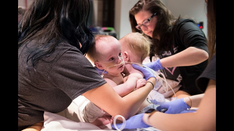 Conjoined identical twin girls separated at Texas Children's Hospital ...