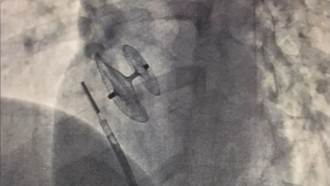 Common but little-known condition leads to stroke in 35-year-old ...