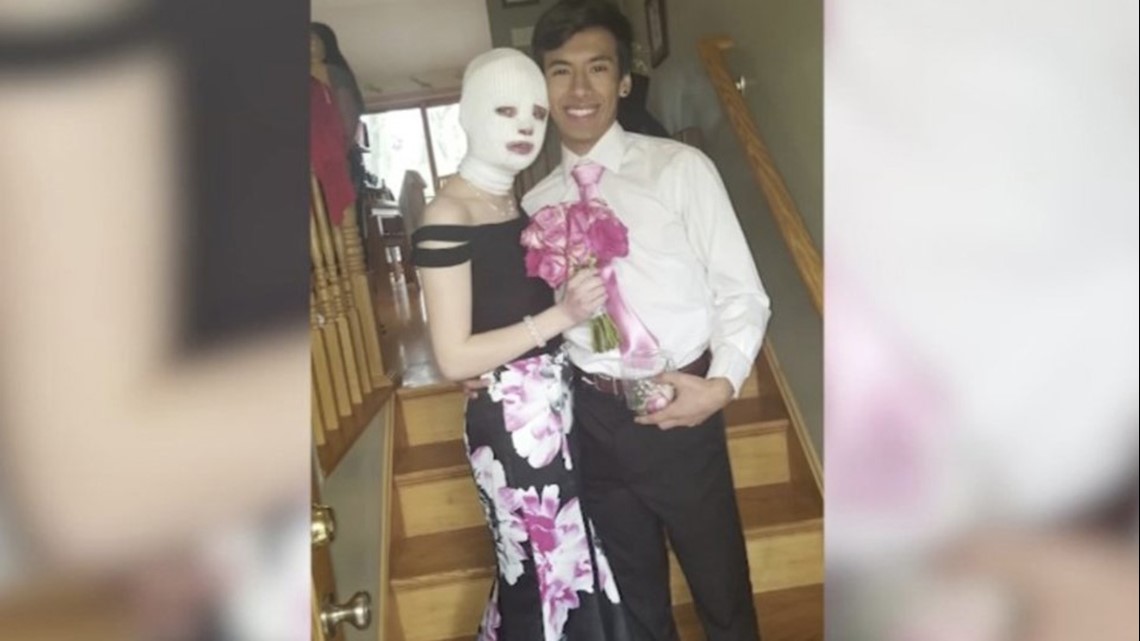 Girl with third-degree burns gets prom night surprise after devastating ...