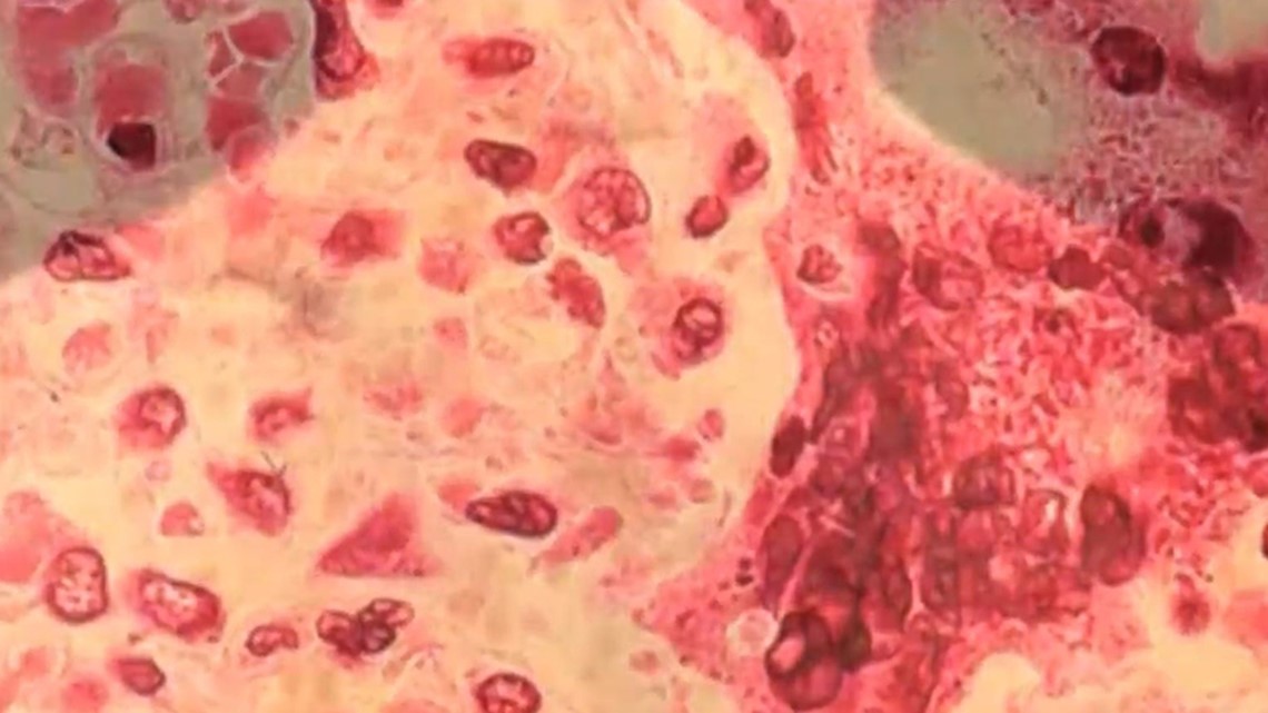 Doctor fears conditions are ripe for measles outbreak in Texas this ...