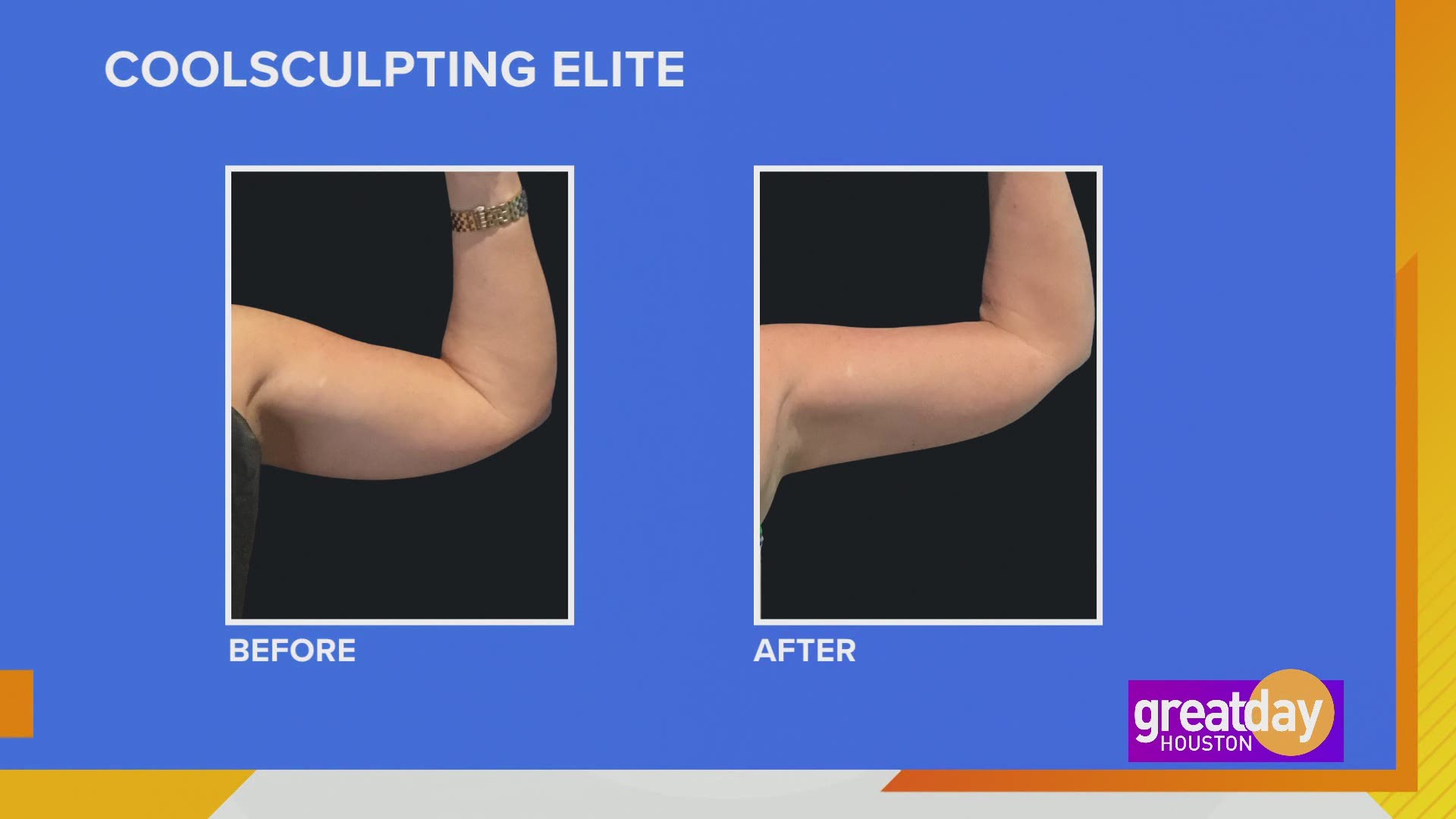 Cool new technology in body contouring | khou.com