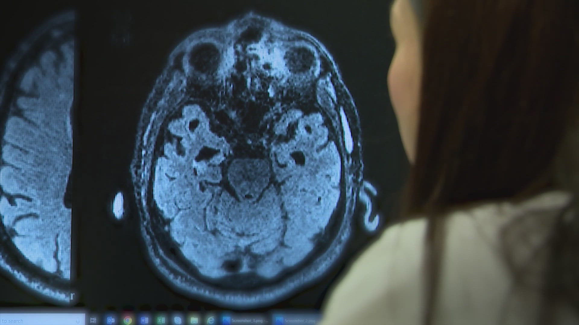 A vote for hope: Prop 14 could change the future of dementia research ...