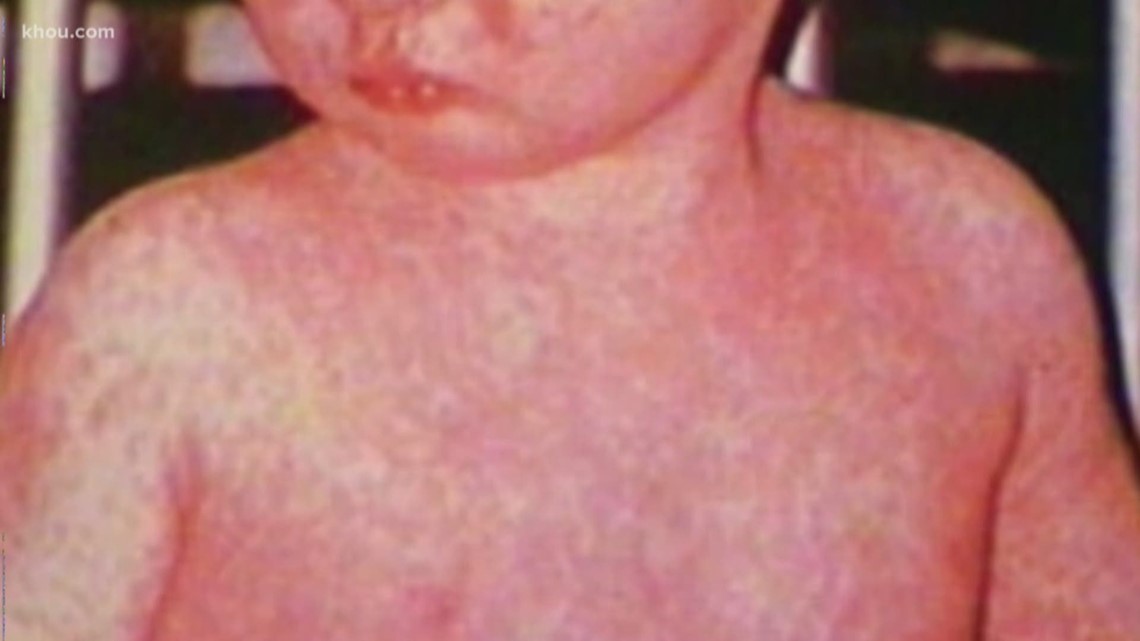 The truth about measles: Experts answer your questions | khou.com