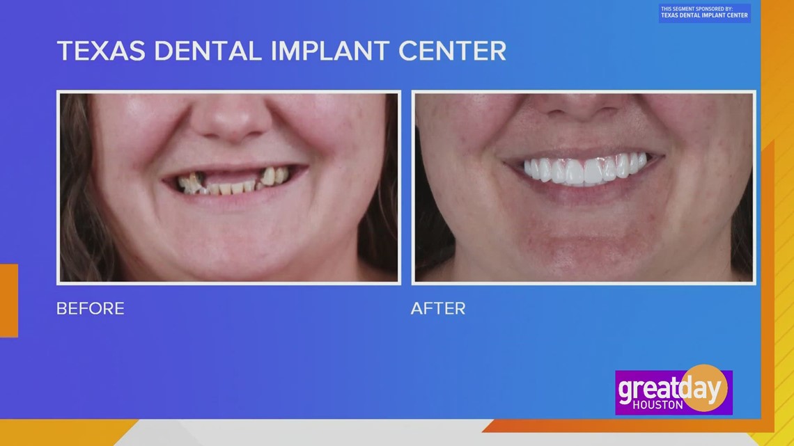 Texas Dental Implant Center can help you transform your life through ...