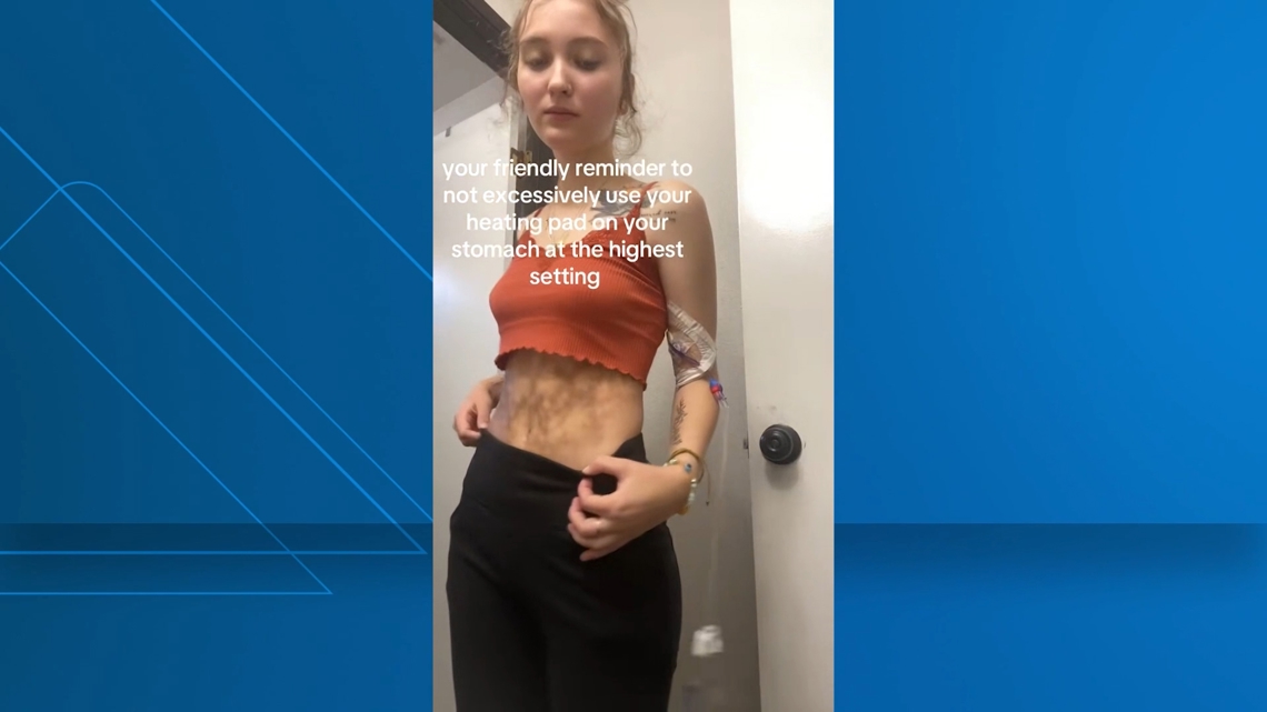 What is ‘Toasted Skin Syndrome?’ | Experts explain the net-like skin ...