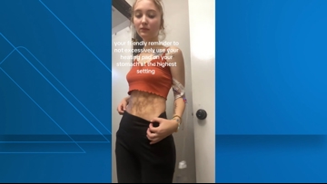 What is ‘Toasted Skin Syndrome?’ | Experts explain the net-like skin ...