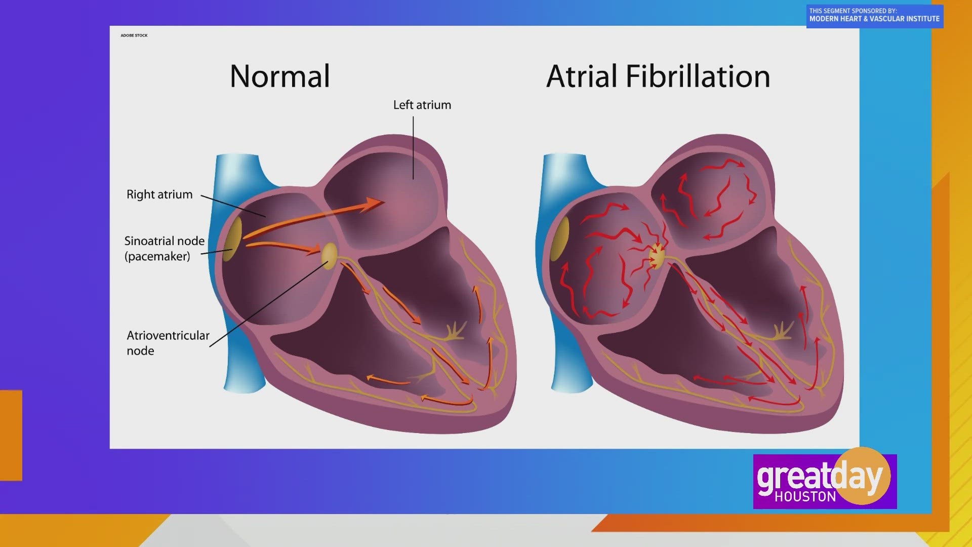 Sponsored Do You Have Afib What To Look For And How To Treat It