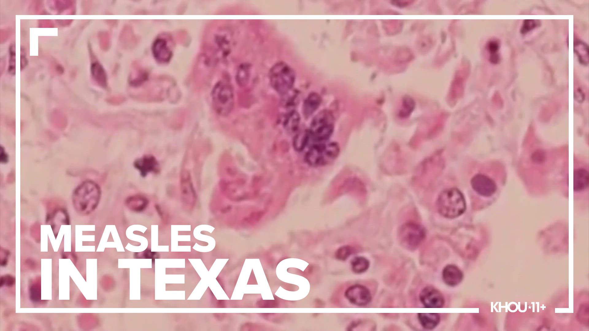 Signs of measles, plus can you get it twice? | Your questions answered ...