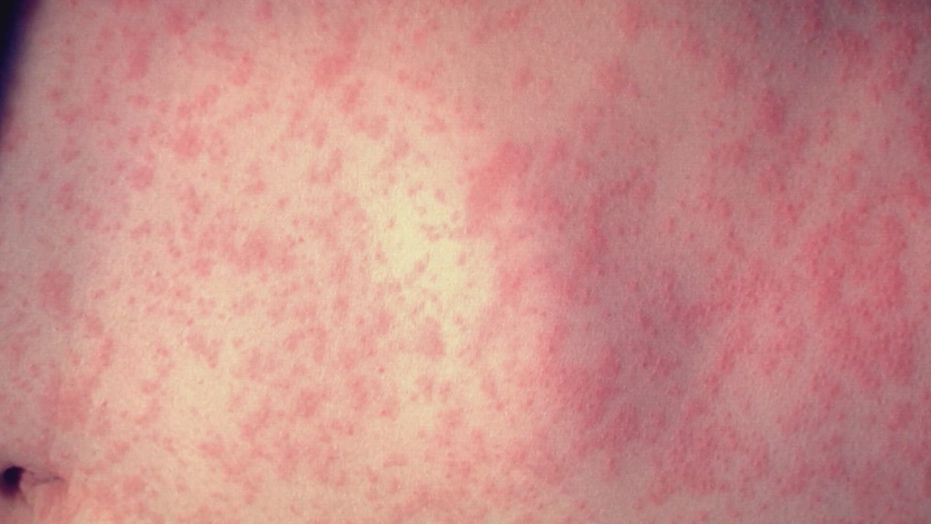Measles outbreak in West Texas continues to grow | khou.com