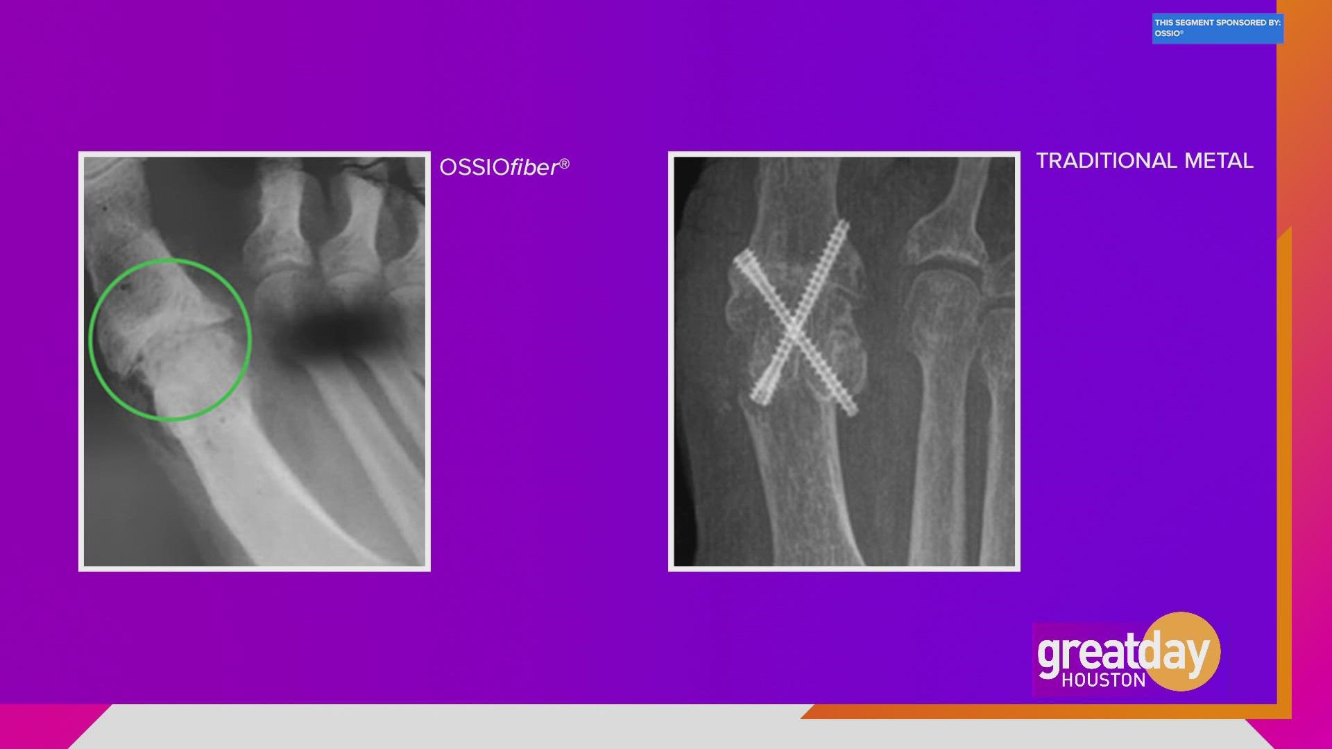 OSSIOfiber® for bunion and hammertoe treatment | khou.com