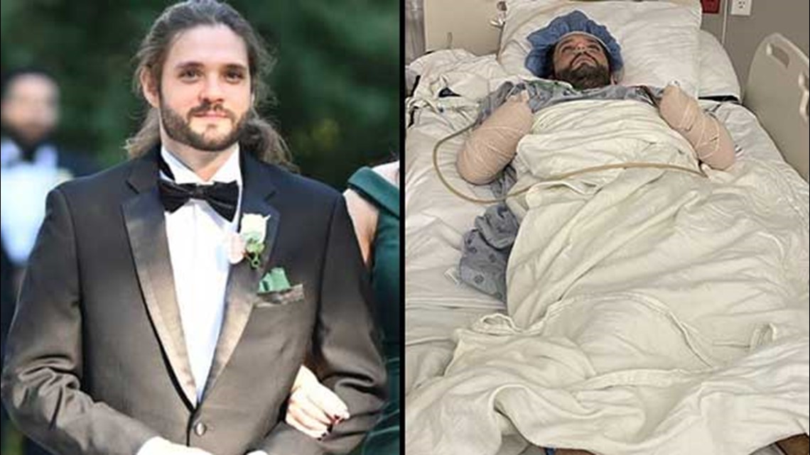 Houston man lost both hands and his toes. It may have started with a ...