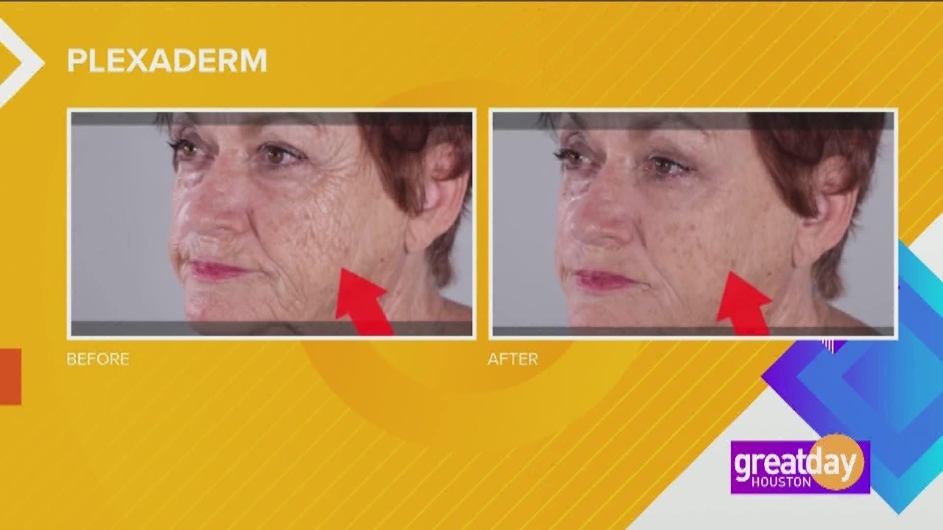 Get rid of under-eye bags with Plexaderm | khou.com