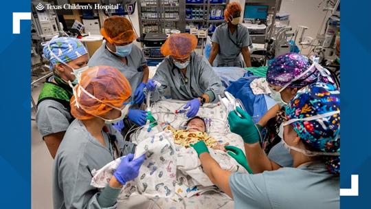 Meet Lucas and Mateo: Formerly conjoined twins separated at TCH | khou.com