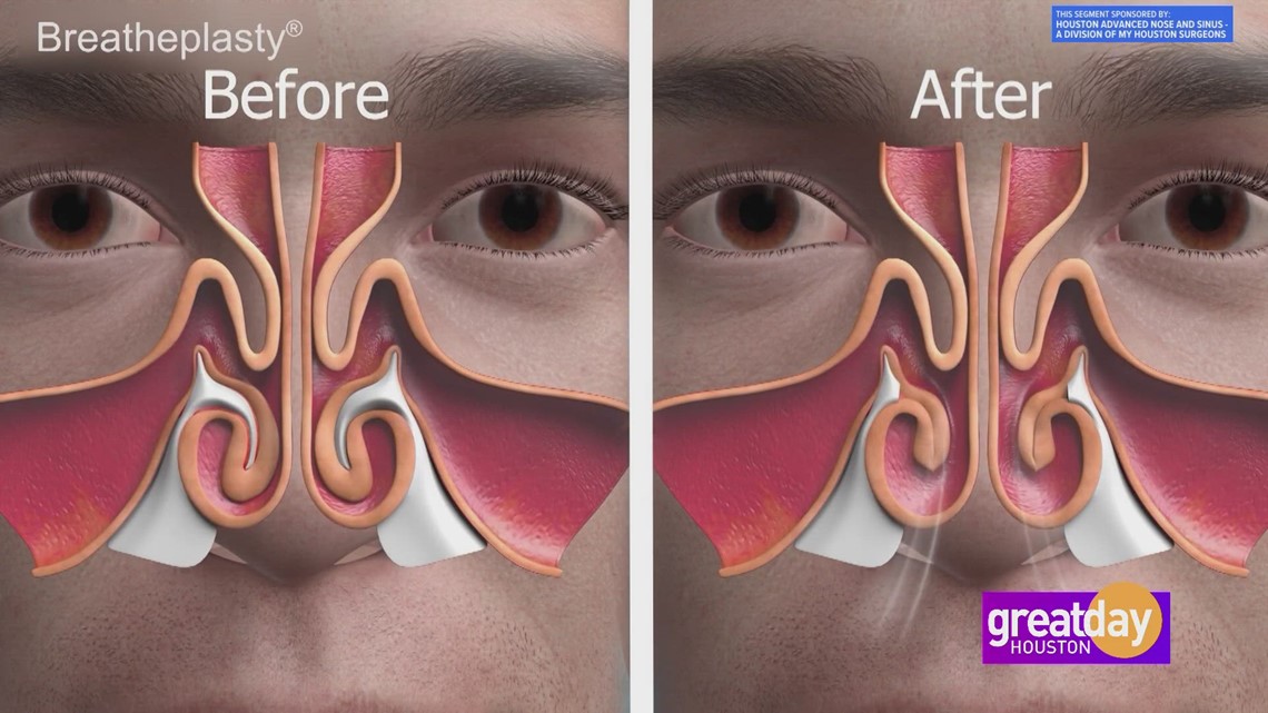 Improve your nasal breathing with help from Houston Advanced Nose and ...