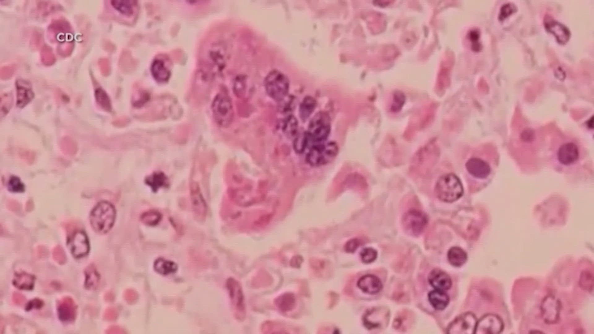 Texas measles outbreak: What we know after first measles death in the U ...