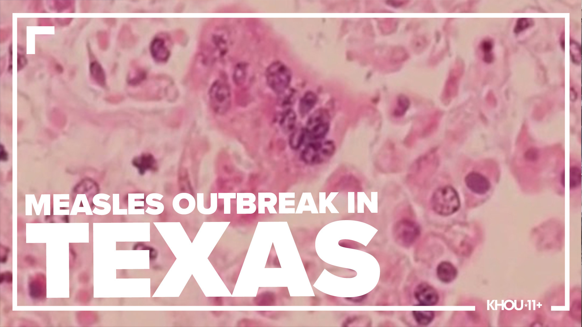 Number of measles cases in Texas rising | How to know if you have ...