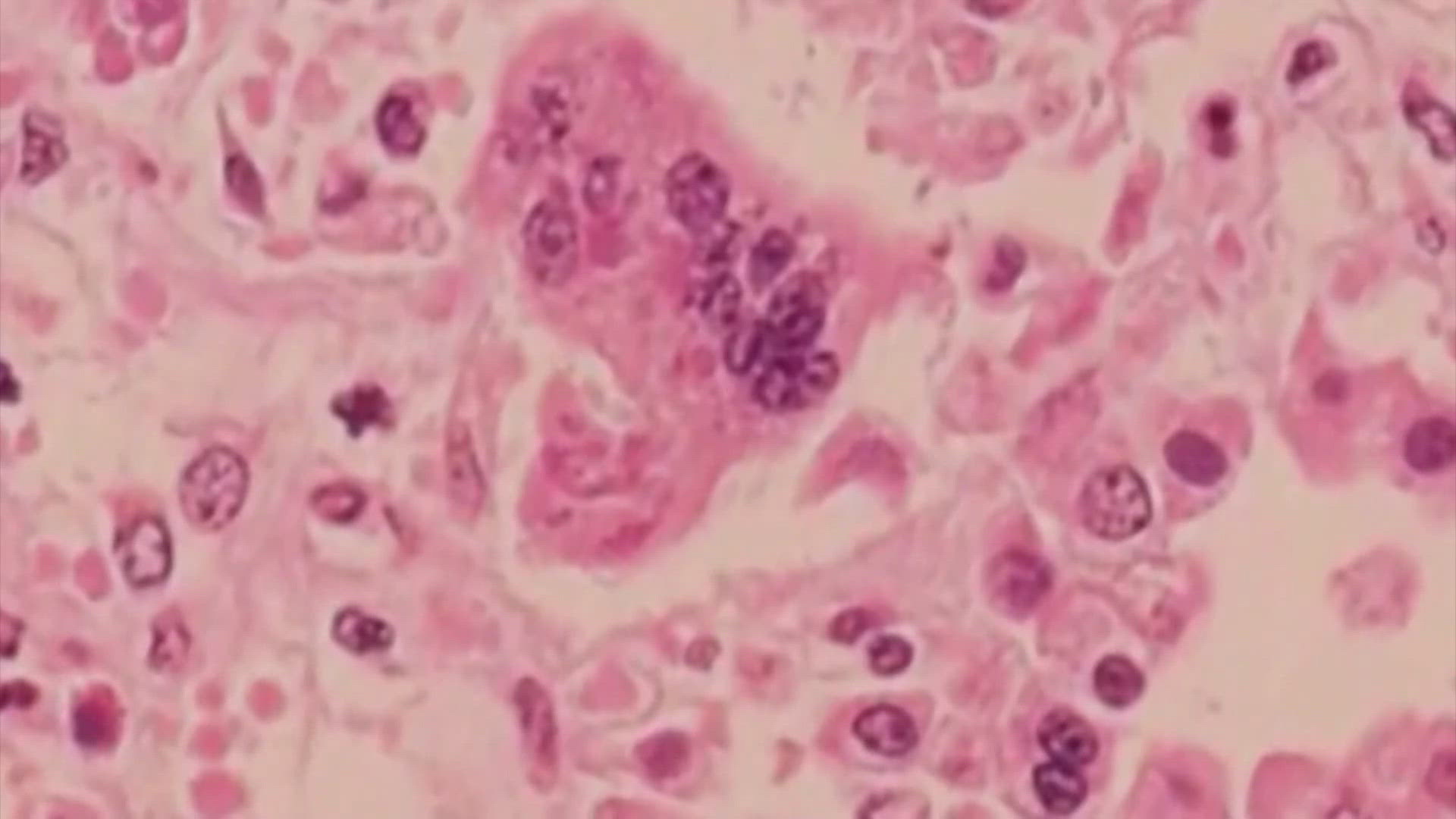 Measles outbreak in Texas reaches 48 cases, experts warn actual number ...