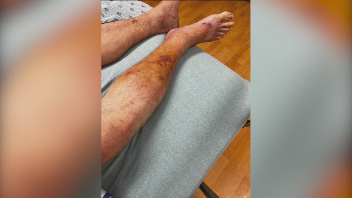 Potential new drug could target flesh-eating bacteria Vibrio | khou.com